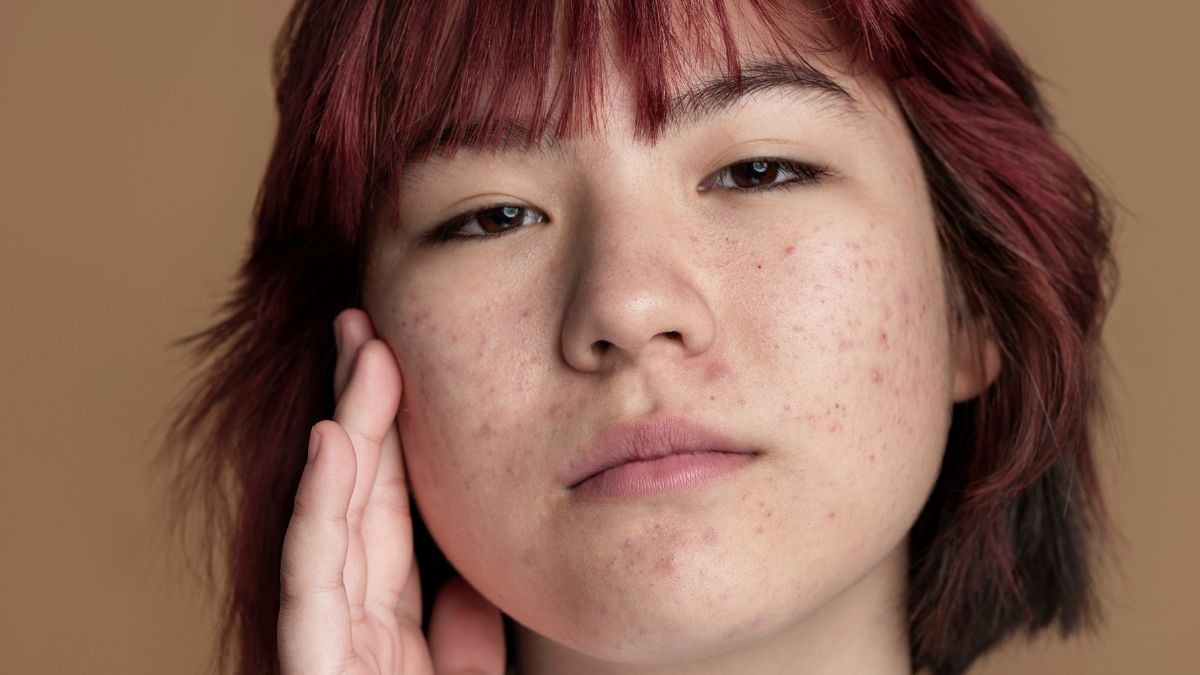 This Natural Ingredient Can Do More Harm Than Good On Your Skin ...