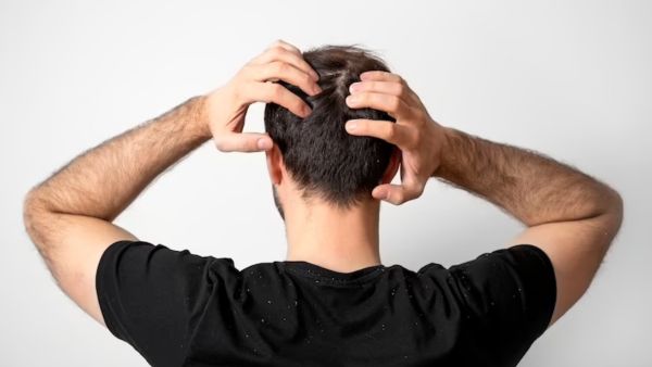 Combating Dandruff in the Indian Climate - The Root Cause to Solution ...