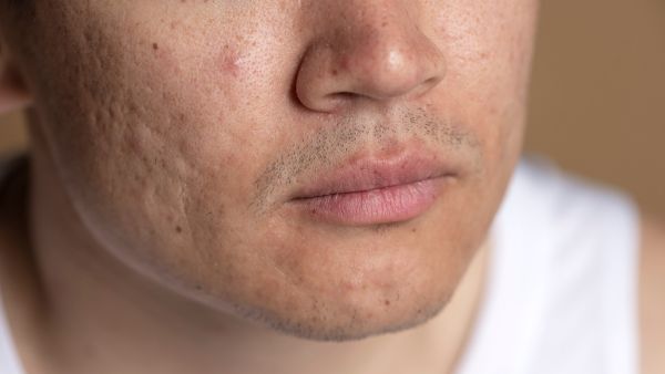 Home Remedies For Chin Pimples: Get Rid Of Pimples Naturally - Boldsky.com
