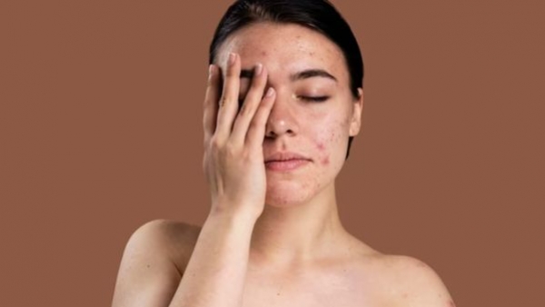 Skincare Routine To Follow For Pimples On Forehead - Boldsky.com