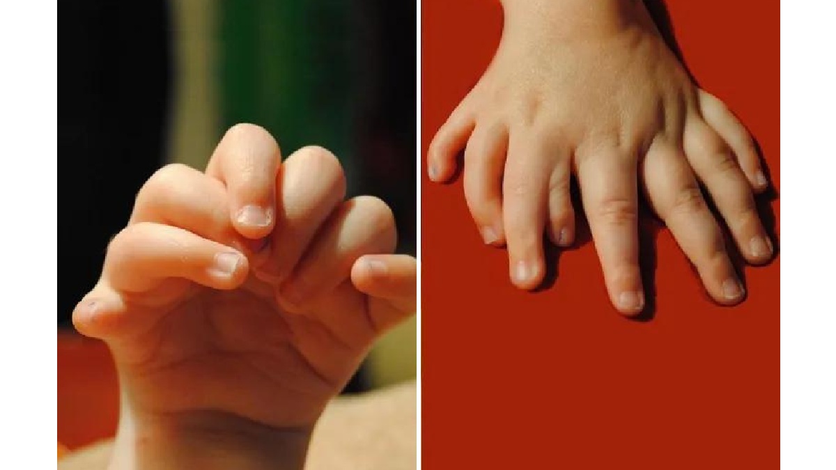 What Is Mirror Hand Syndrome? Diagnosis, Treatment, And Awareness ...