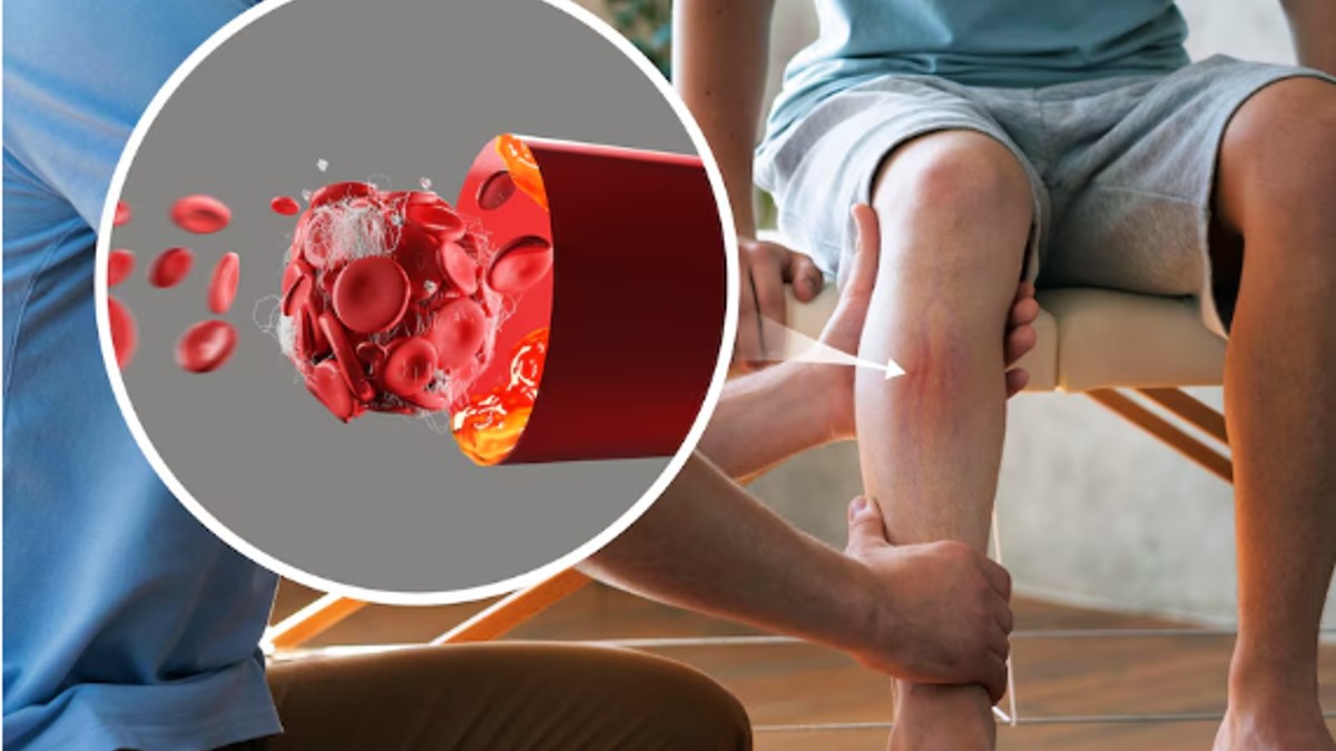 How Do You Know If A Blood Clot In Your Leg Is Life Threatening? Signs ...
